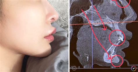 Popular Models Shocking Face X Rays Expose Horrors Of Plastic Surgery Koreaboo