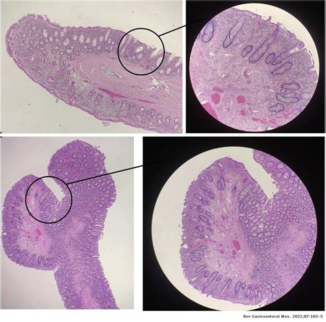 Filiform Polyposis A Rare Complication In A Patient With Inflammatory