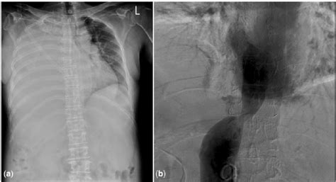A Chest Radiography Showed A Massive Pleural Effusion With Tracheal