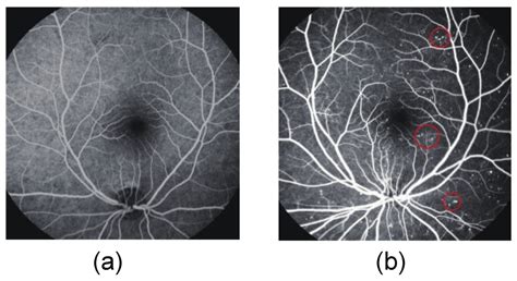 An Improved Microaneurysm Detection Model Based On Swinir And Yolov8