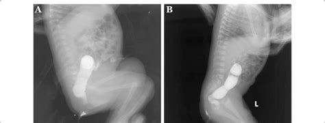 Contrast Enema Reveals A Transition Zone In A Rectum And B Rectosigmoid Download Scientific