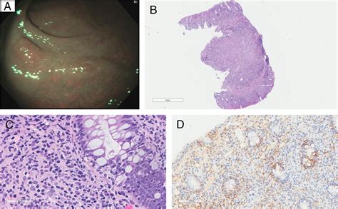 A Case Of Asymptomatic Syphilitic Proctitis Sexually Transmitted Diseases