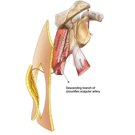Schematic Diagram Demonstrating The Anatomy Of The Parascapular Flap