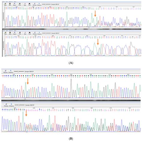 Primary Adrenal Insufficiency Complete Sex Reversal And Unique