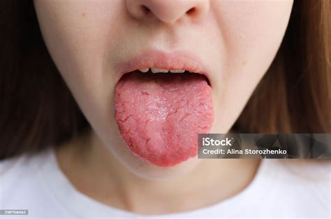 Tongue Problems Woman With Geographical Tongue Migratory Glossitis