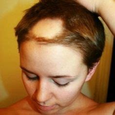 1000 Images About Alopecia Women On Pinterest Miss America Beauty Queens And Bald Women