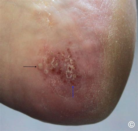 Pustular Psoriasis Face