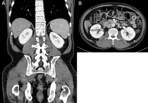 Fdg Petct In Hantavirus Hemorrhagic Fever With Renal Syndro