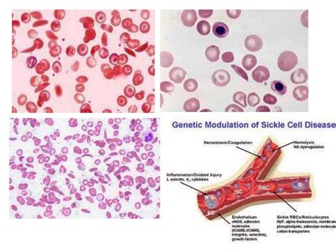 Normochromic Normocytic Anaemia Pptx
