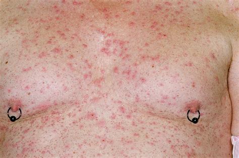 Red Spots On Chest Heart At Gwen Green Blog