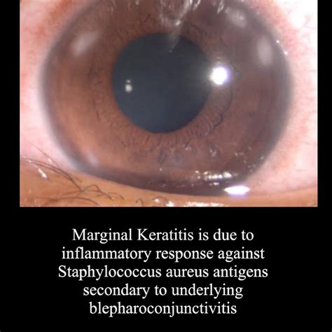 Marginal Keratitis — Ophthalmobytes