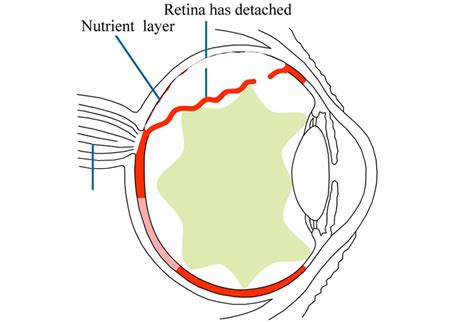 Retinal Detachment Torn And Detached Retina Retina Eya Care P C