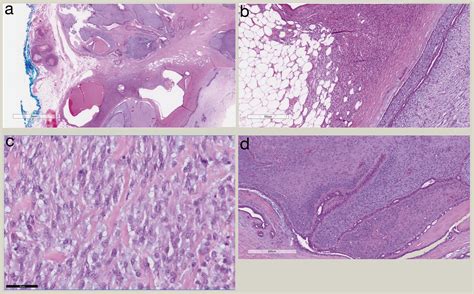 An Update On The Classification Of Phyllodes Tumours Of The Breast