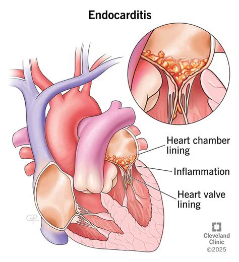 Bacterial Endocarditis Vegetation