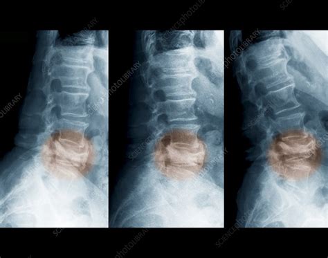 Spinal Compression Fractures X Ray Stock Image C0252476 Science Photo Library