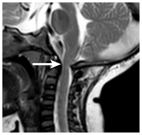 Foramen Magnum Mri
