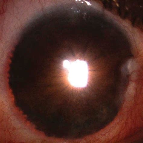 Hypochromic Lesion Compatible With Vitiligo Download Scientific Diagram