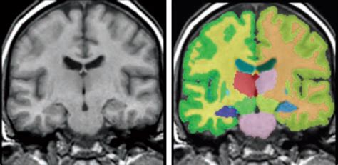 Comparaison Quantification Vs Segmentation