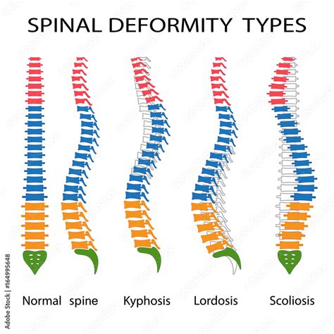 Spinal Deformity Types Stock Vector Adobe Stock