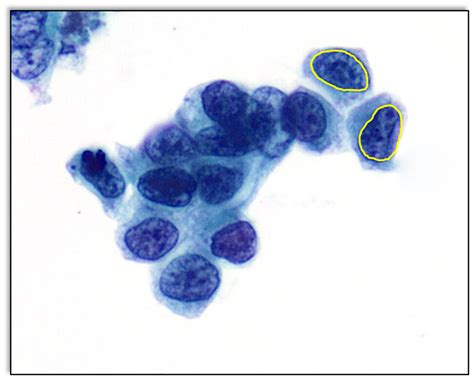 Transitional Cell Carcinoma Cytology