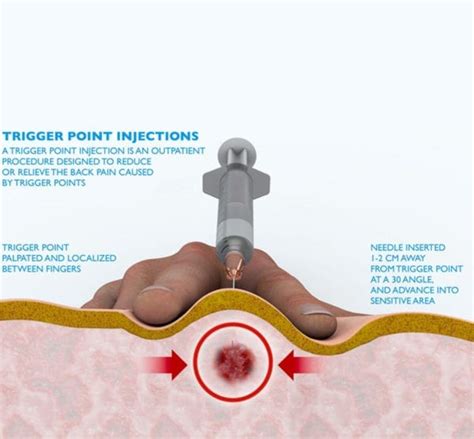 Trigger Point Injections Dr Sam Personal Injury And Trauma Psychiatry Doctor In San Antonio