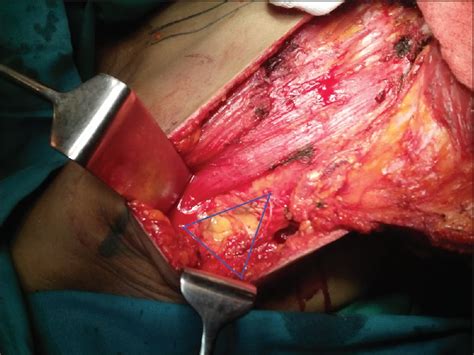 Pectoralis Block For Breast Surgery A Surgical Concern Pmc