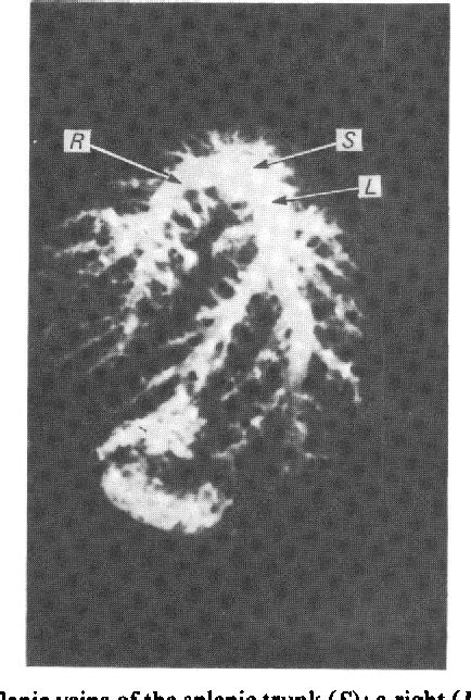 Figure 1 From Anatomical Note Venous Segmentation In The Spleen Of The