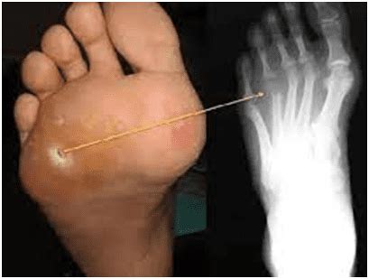 What Is Osteomyelitis And How Is It Caused Causes And Best Treatment