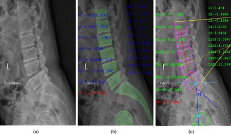 Figure 1 From Multitask Deep Learning For Segmentation And Lumbosacral Spine Inspection