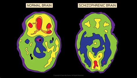 The Dopamine Hypothesis And Schizophrenia A Level Psychology