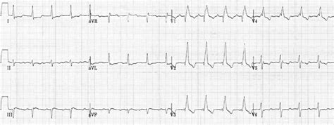 Right Bundle Branch Block Rbbb • Litfl • Ecg Library Diagnosis