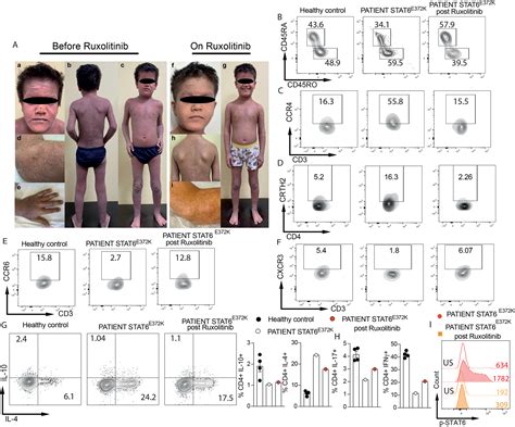 Severe Allergic Dysregulation Due To A Gain Of Function Mutation In The Transcription Factor