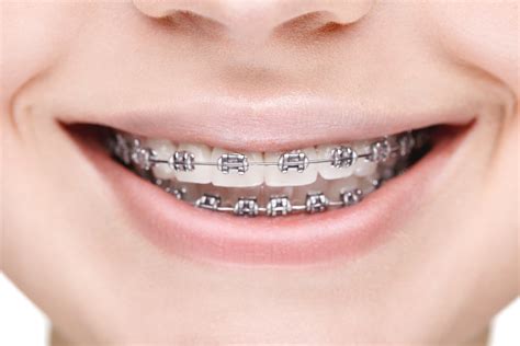 Your Visual Guide To Different Types Of Braces Langley Braces Aura