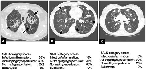 The Spectrum Of Structural Abnormalities On Ct Scans From Patients With Cf With Severe Advanced