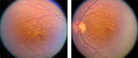 Retinal Physician Pentavision