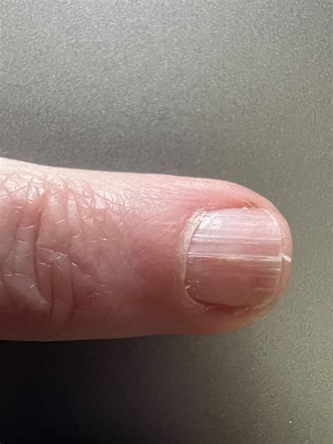 Splitting Nail Rdermatologyquestions