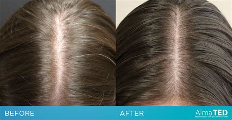 Hair Restoration Before And After Treatment Photos