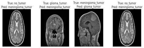 Advancing Brain Tumor Detection Harnessing The Swin Transformers Power For Accurate
