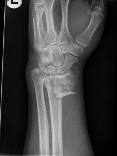 adv anatomy bone fractures flashcards quizlet