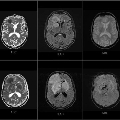 A Mri Brain Wwo Contrast Diffusion Restricting Lesions In Right
