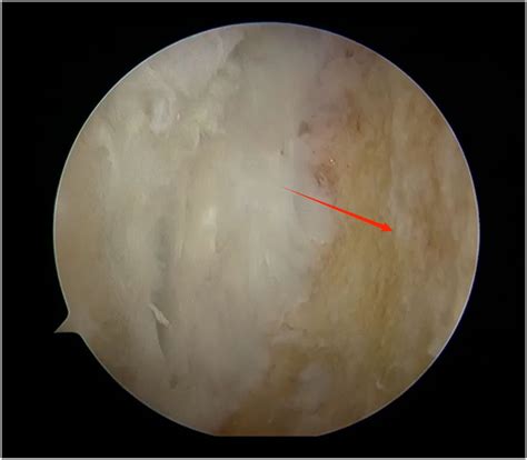 Arthroscopic Tibial Tubercle Osteophyte Debridement And Gout Crystal