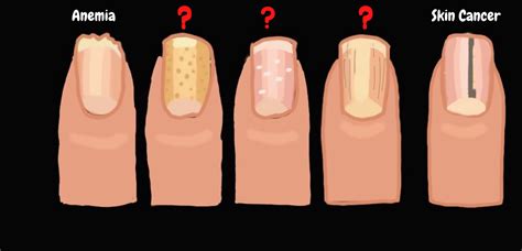 What Do Fingernails Look Like With Cancer At Jayden Leadbeater Blog