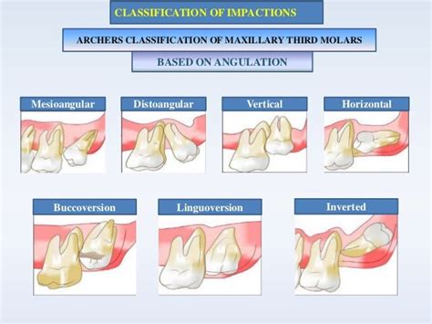Impaction