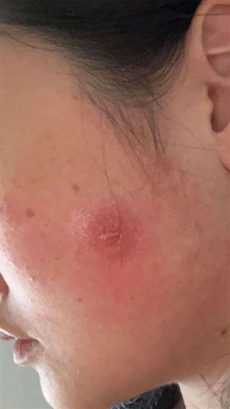 Potential Staph Infection Lots Of Drainageexudate Tried