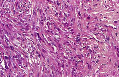 Fibrosarcoma Light Micrograph Stock Image C060 1170 Science Photo Library