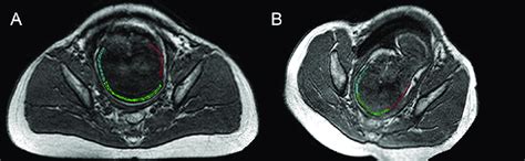Mri Measurement Of Fetal Head Molding In Patient 1 A Axial Mri