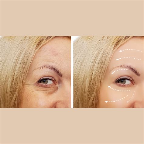 Botox Before And Afters In Frederick Tips For Fantastic Results Hagerstown
