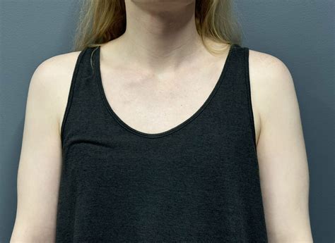 Plastic Surgery Case Study Shoulder Narrowing Surgery With The Use Of Double Plates Explore
