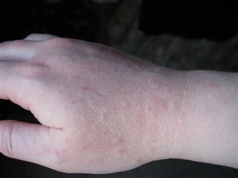 Rashes On Arms