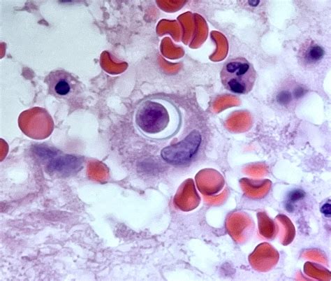 Case Of Blastomyces With All Classic Features Dimorphic Fungus That